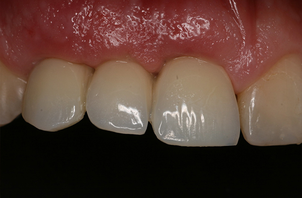 Zahnentfernung - Prof. Dr. Michael Korsch